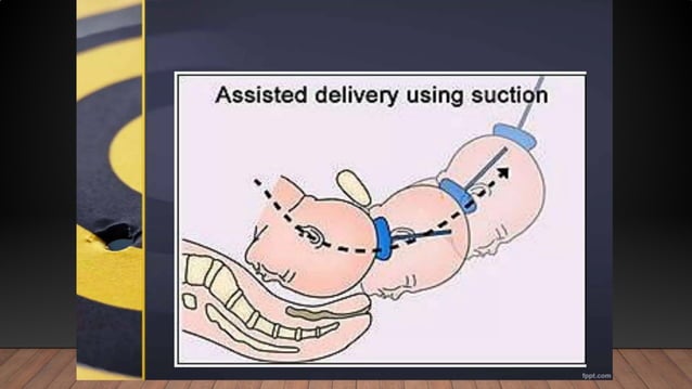 SOLWEZI GENERAL HOSPITAL assisted vaginal delivery.pdf