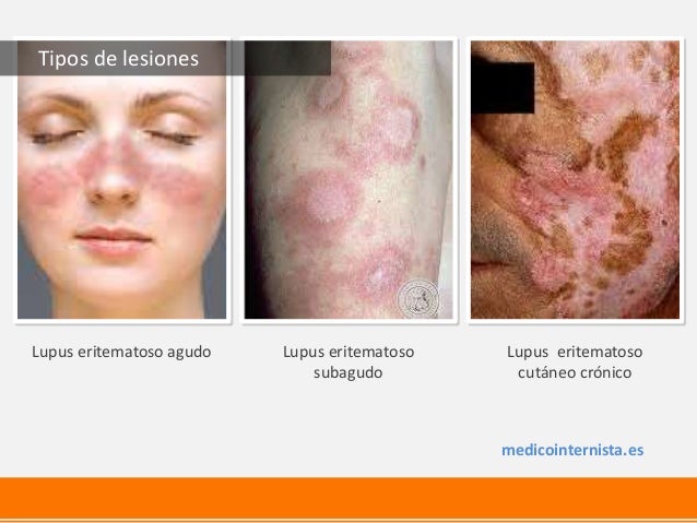 Sol Y Lupus Eritematoso