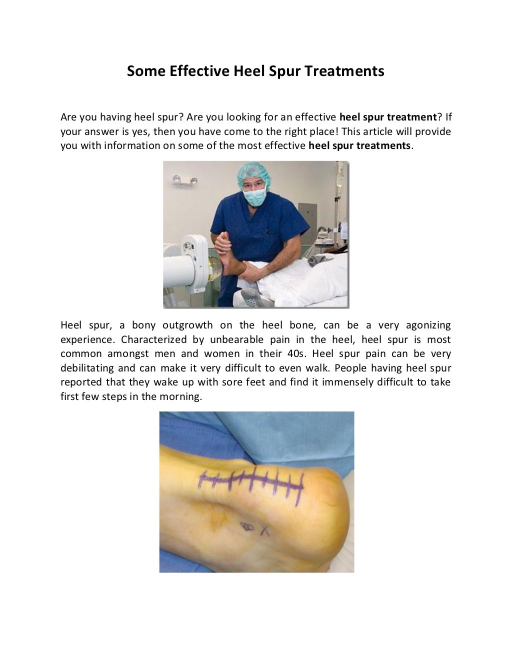 Some Effective Heel Spur Treatments