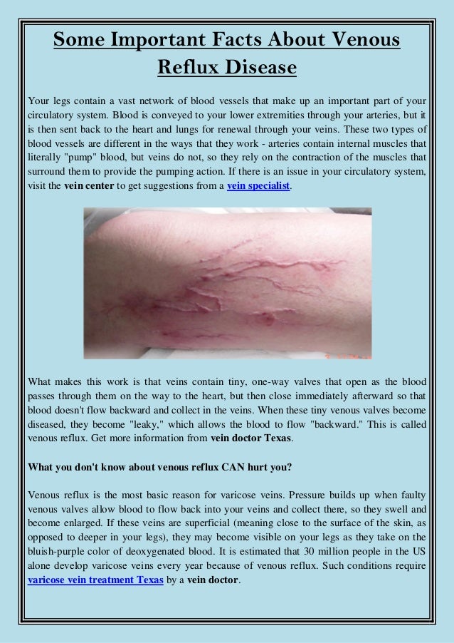 Some important facts about venous reflux disease Some important facts about venous reflux disease