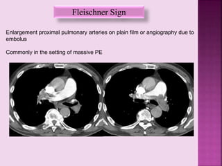 Some radiological sig | PPSX