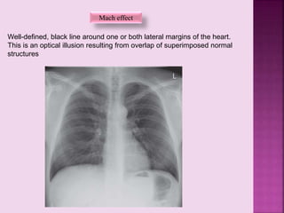 Some radiological sig | PPSX