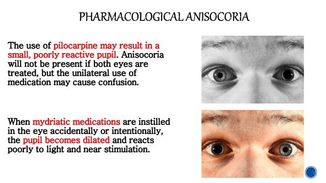 Abnormal Pupil Position