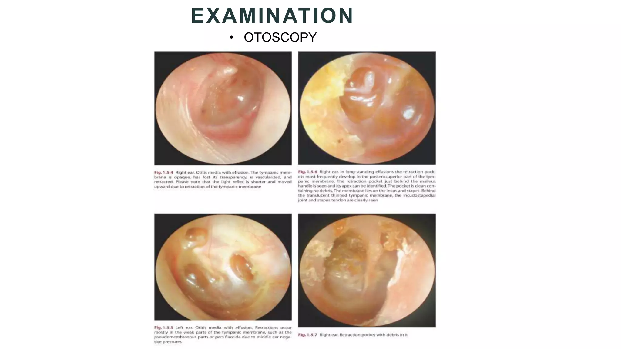 Serous Otitis media and Grommets | PPTX