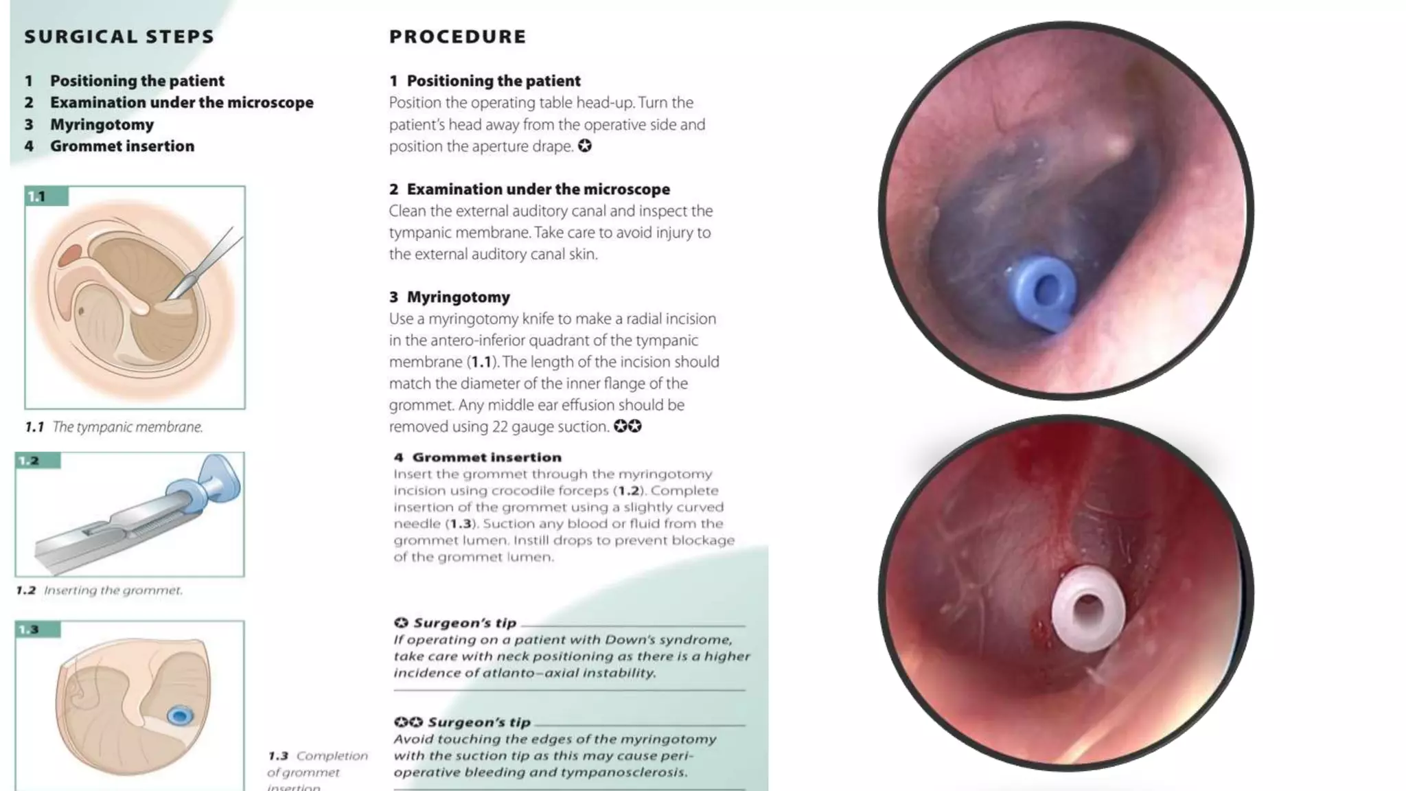 Serous Otitis Media And Grommets PPTX Serous Otitis Media And Grommets PPTX