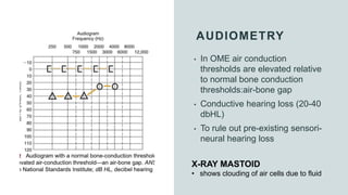 Serous Otitis media and Grommets | PPTX