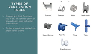 Serous Otitis media and Grommets | PPTX