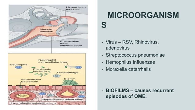 Serous Otitis media and Grommets | PPTX