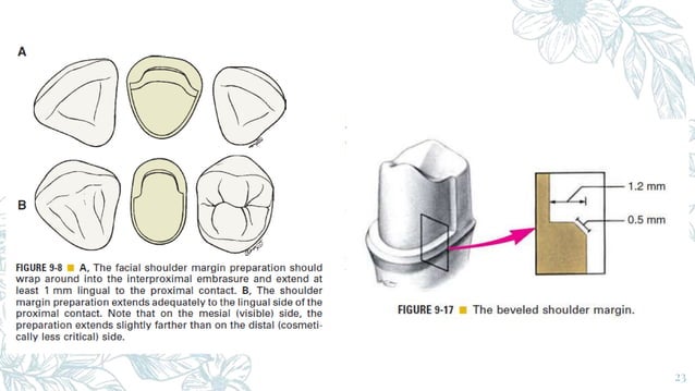 preparation for full coverage restorations .pptx
