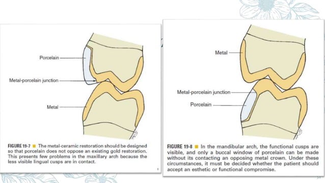 preparation for full coverage restorations .pptx