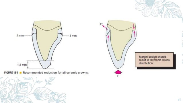 preparation for full coverage restorations .pptx