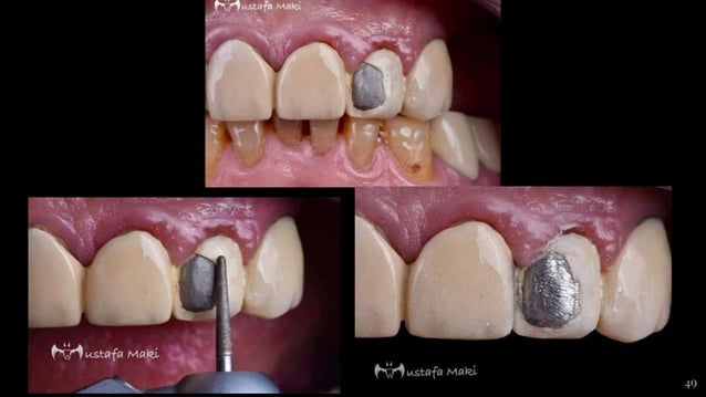 preparation for full coverage restorations .pptx