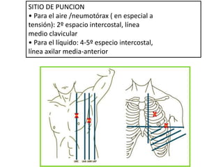 COLOCACION DE SONDA ENDOPLEURAL, ZIP TECNICAS | PPTX