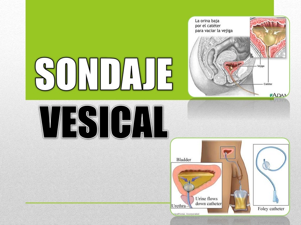 Sondaje vesical
