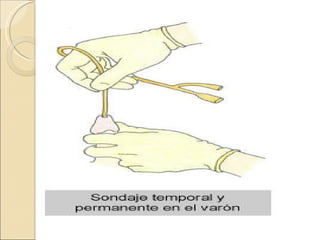 Sondaje vesical | PPT