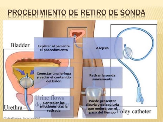 Sondaje vesical masculino