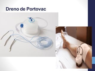 sondas_cateteres_drenos_AULA_5_pptx;filename=_UTF_8''sondas,_cateteres.pdf