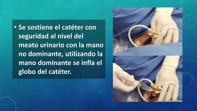 Colocación de sonda Foley en hombre y mujer (Sondaje Vesical) | PPTX