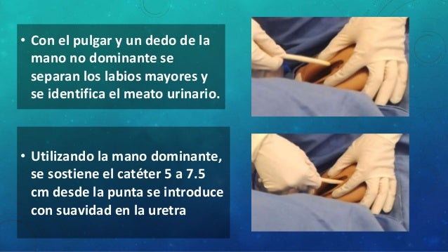Colocación de sonda Foley en hombre y mujer (Sondaje Vesical)