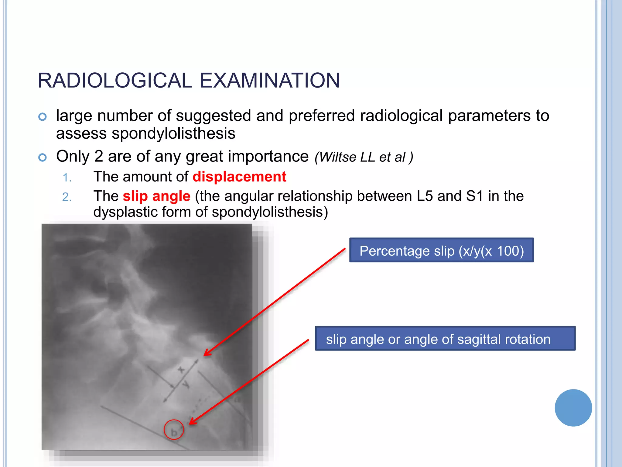 Spondylolisthesis | PPTX