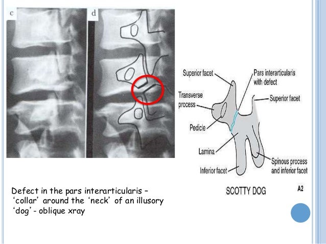 Spondylolisthesis
