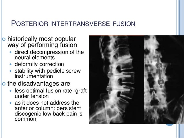Spondylolisthesis