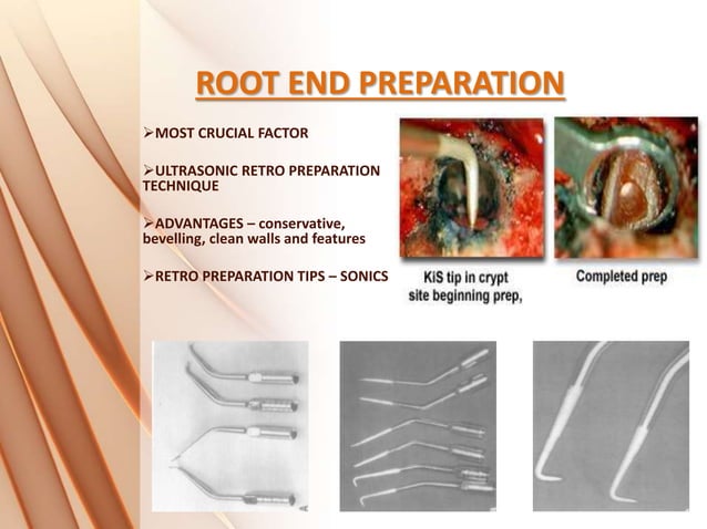 Sonics and ultrasonics in endodontics | PPT | Oral care | Personal Care