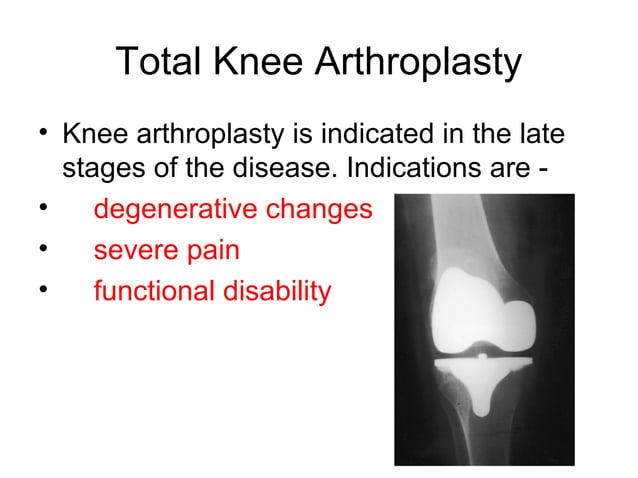 Spontaneous OsteoNecrosis of Knee (SONK) | PPT