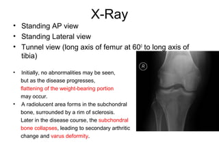 Spontaneous OsteoNecrosis of Knee (SONK) | PPT