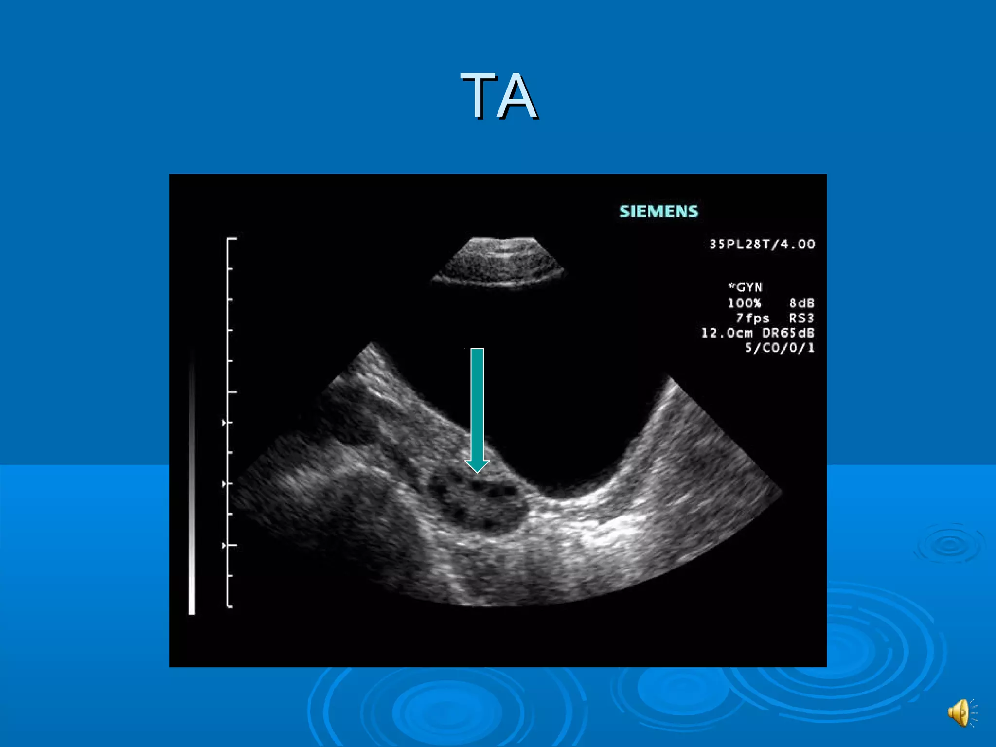 Sono 202 normal gyn anatomy | PPT