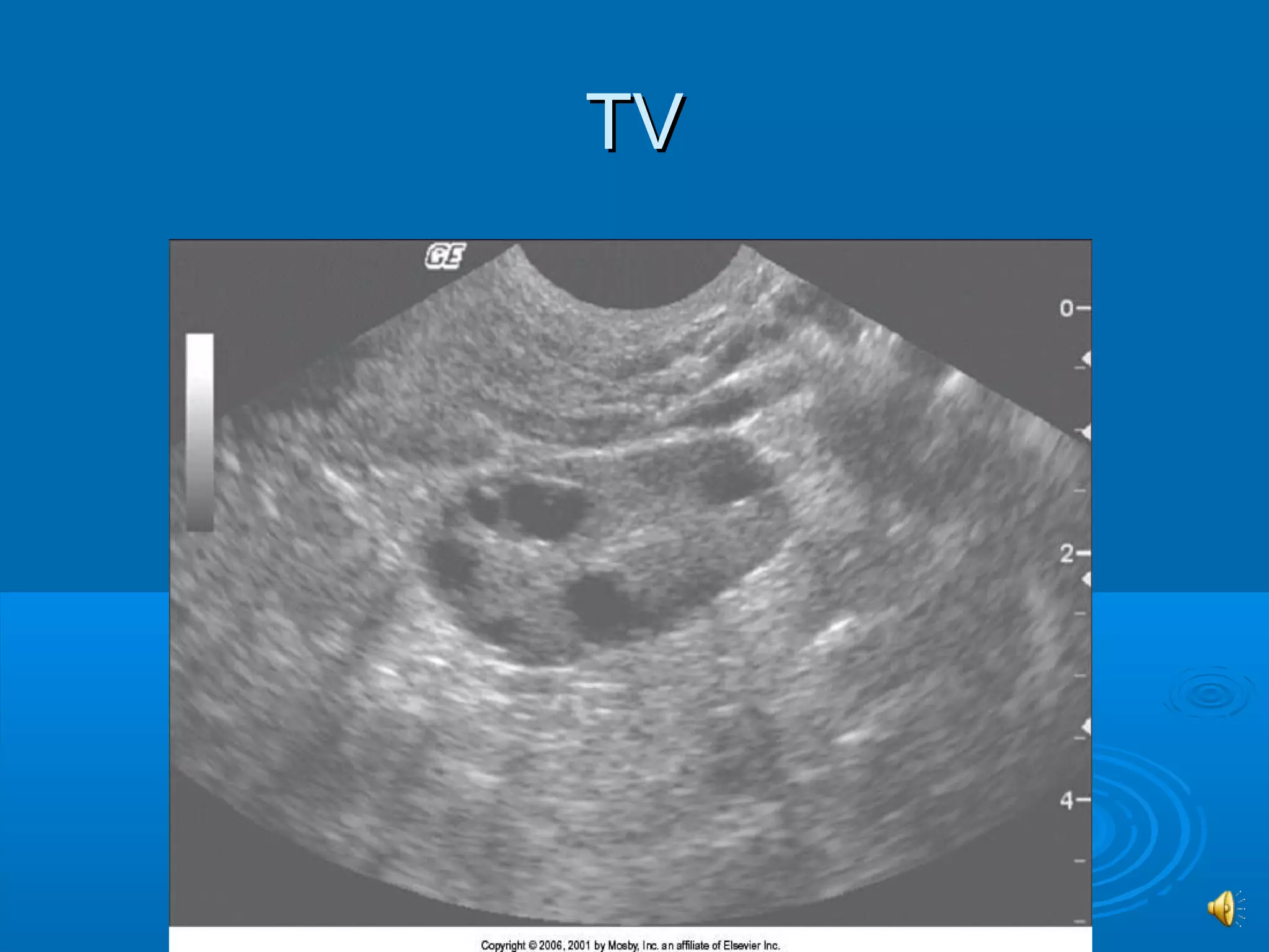 Sono 202 normal gyn anatomy | PPT