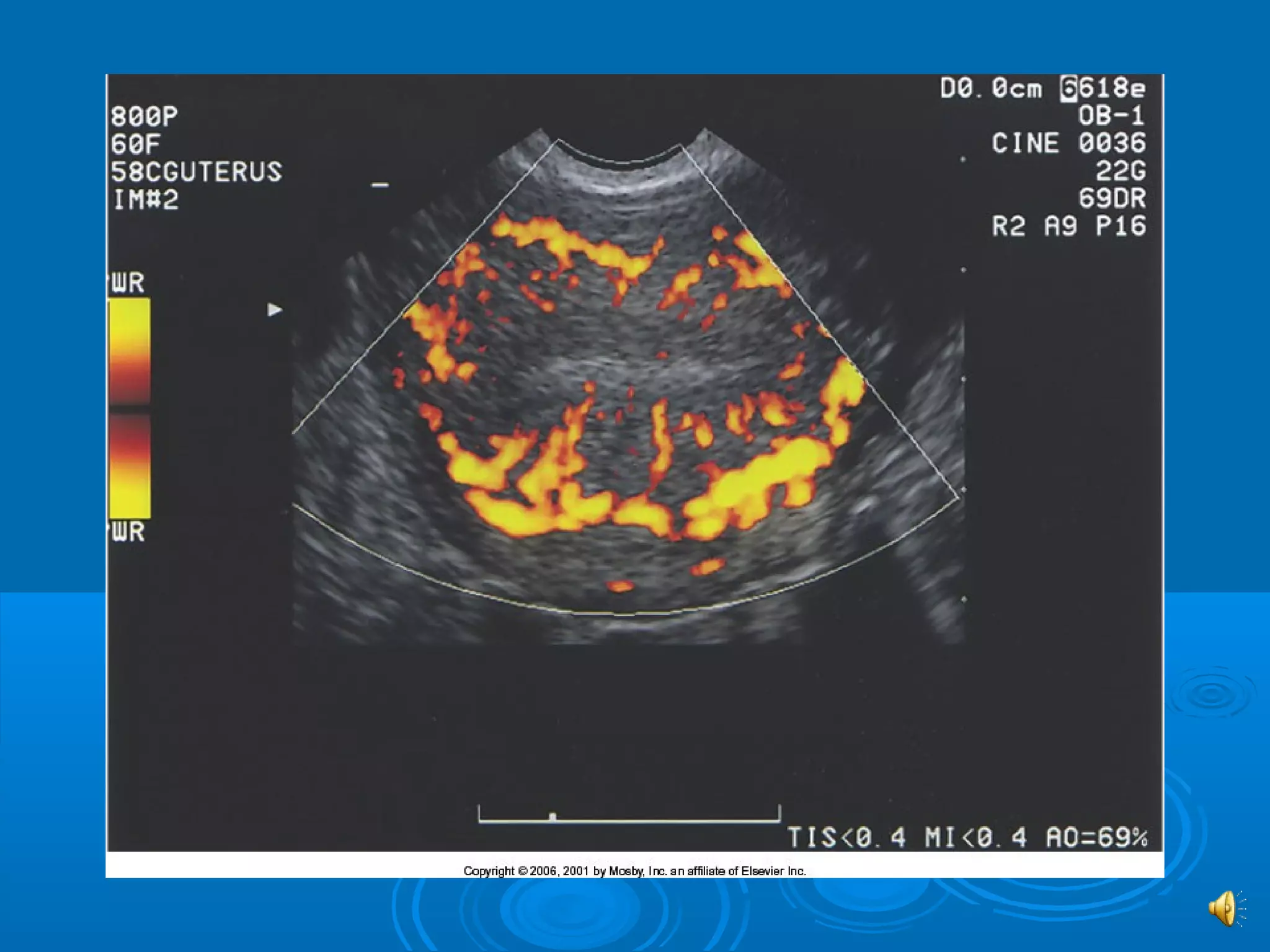 Sono 202 normal gyn anatomy | PPT
