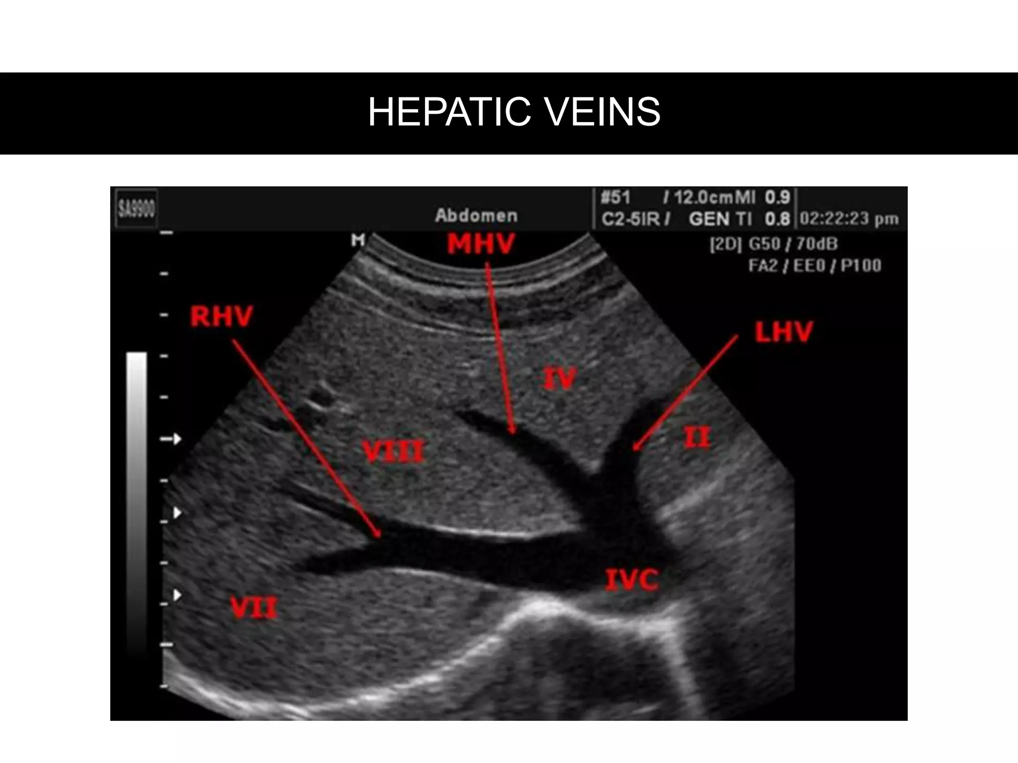 Sonographic anatomy of abdomen and pelvic organ | PPTX