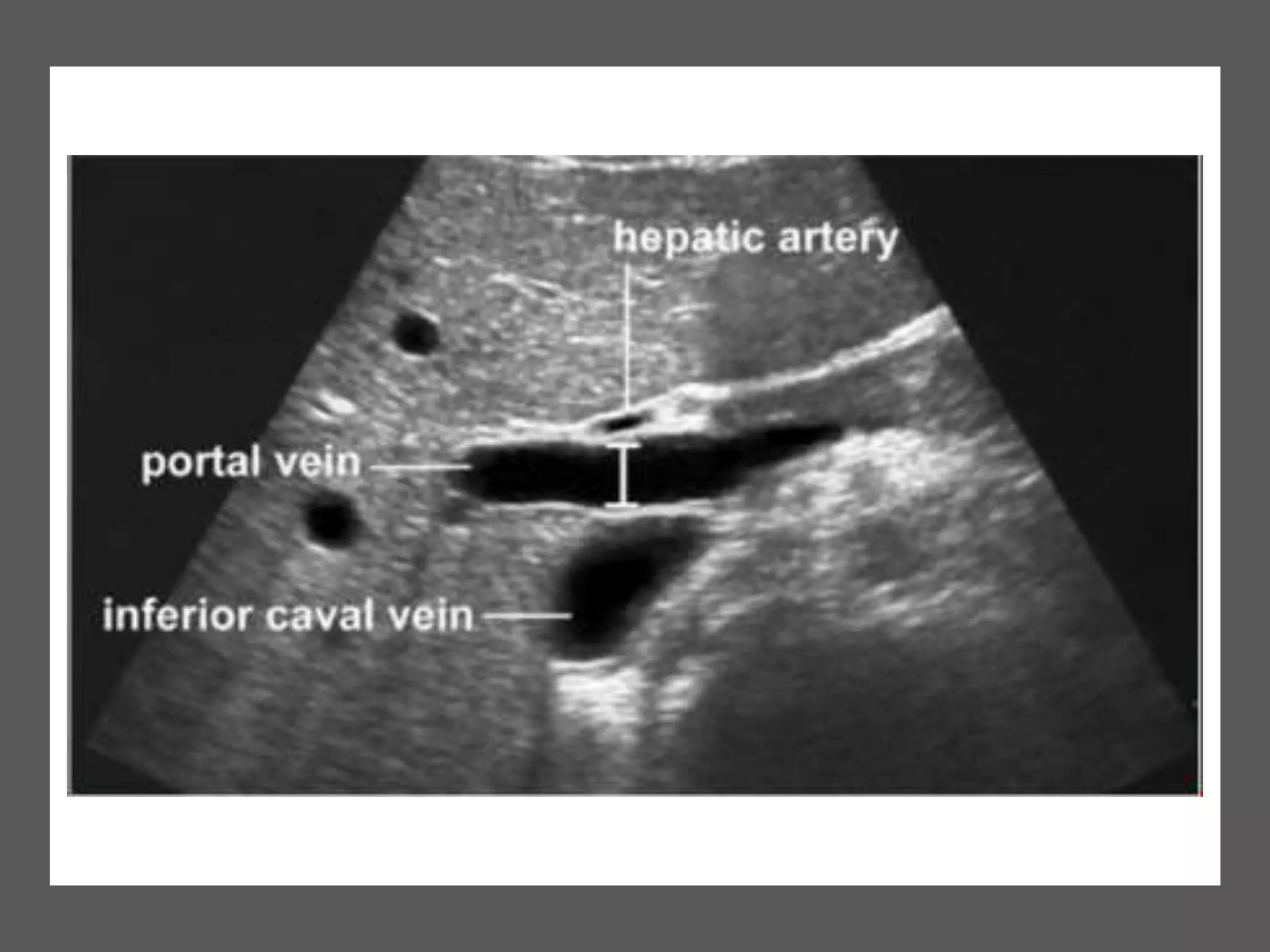 Sonographic anatomy of abdomen and pelvic organ | PPTX