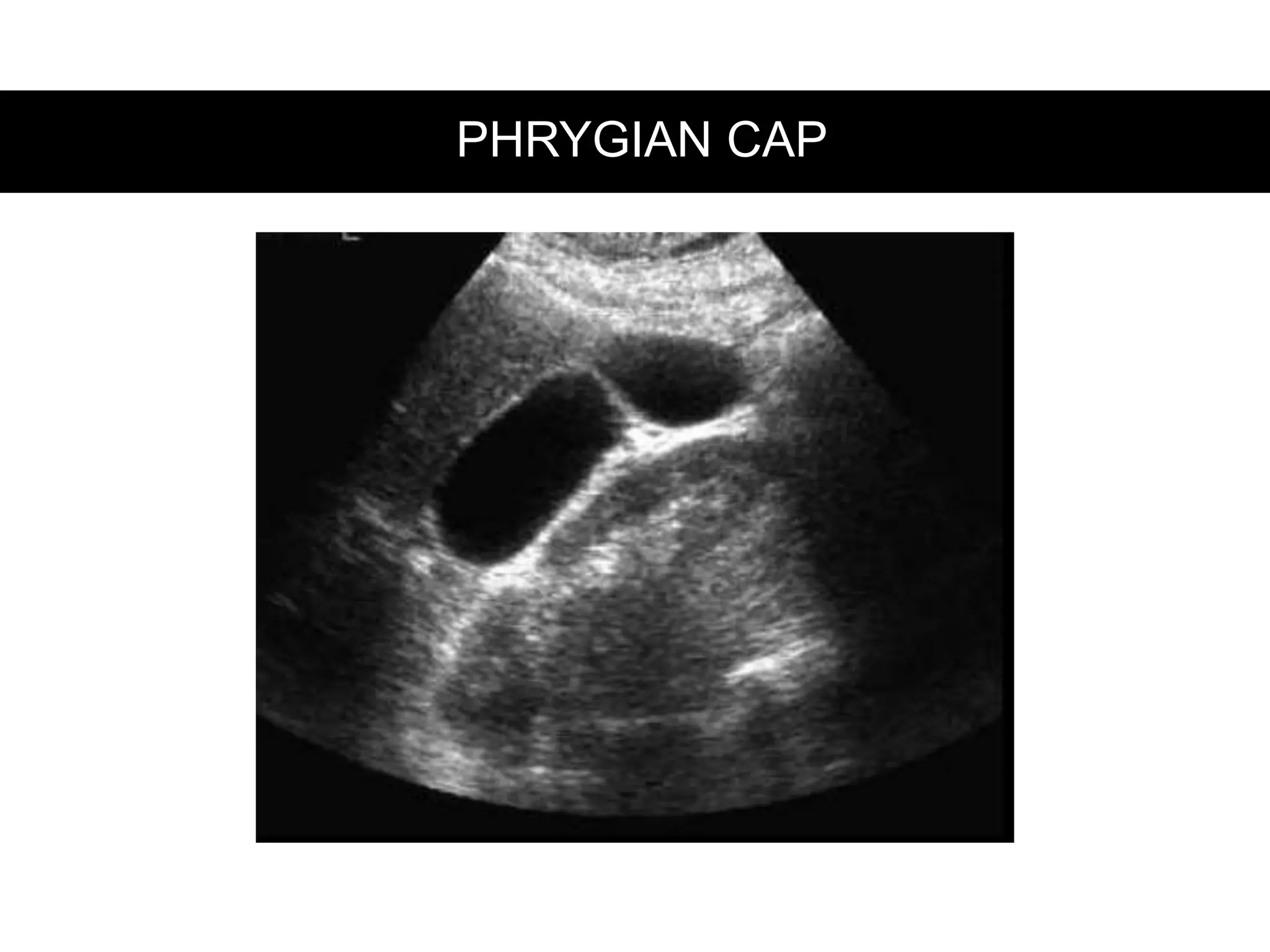 Sonographic anatomy of abdomen and pelvic organ | PPTX