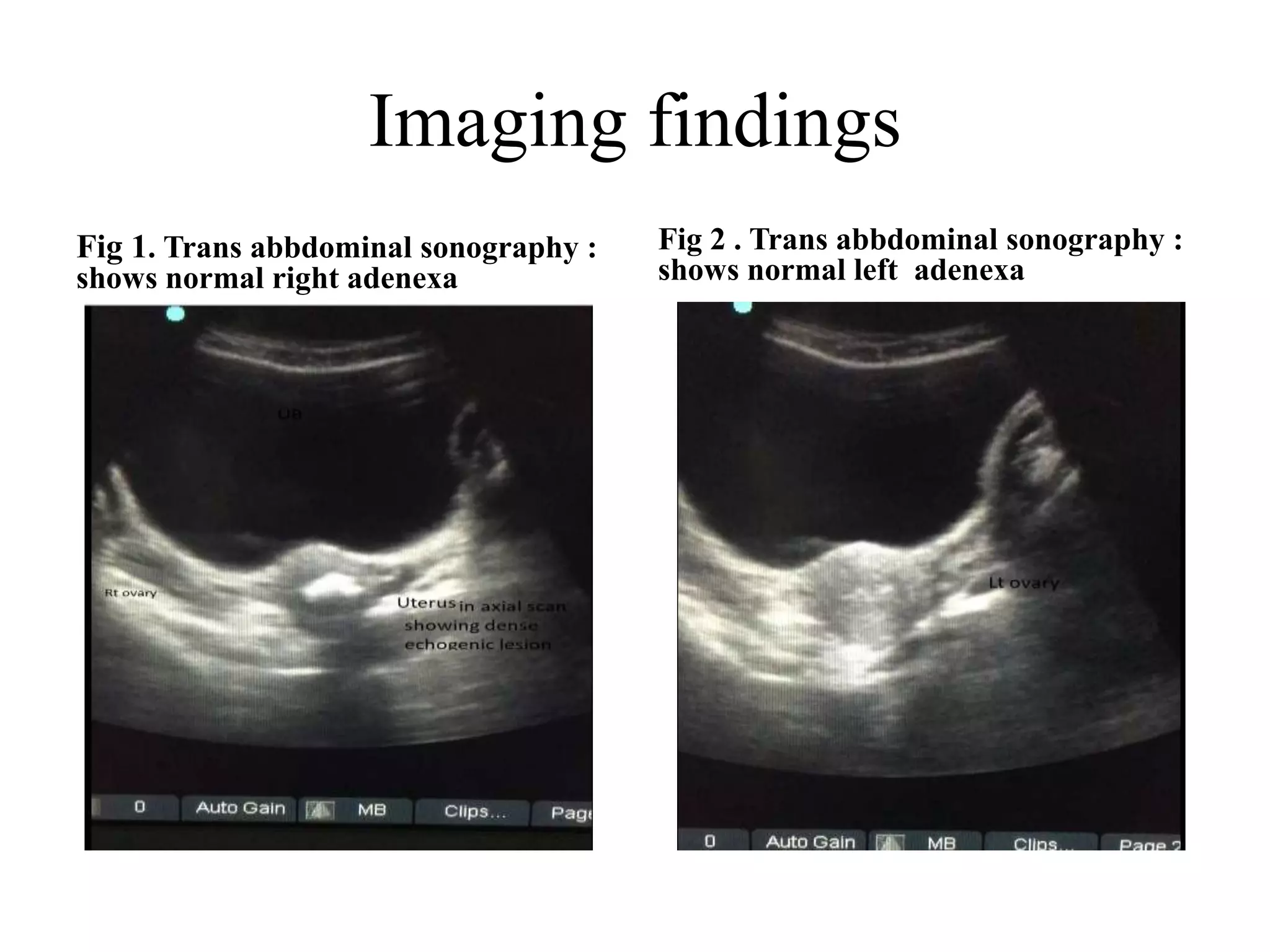 Sonographic appearance of endometrial osseous metaplasia | PPTX