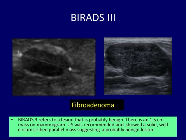Sonographic evaluation of breast Dr. Muhammad Bin Zulfiqar