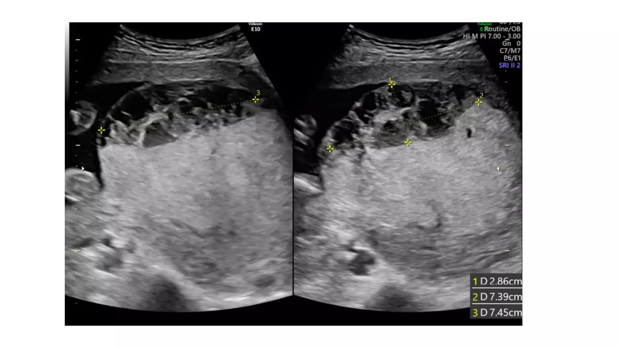 Sonographic Evaluation of Placenta.pptx