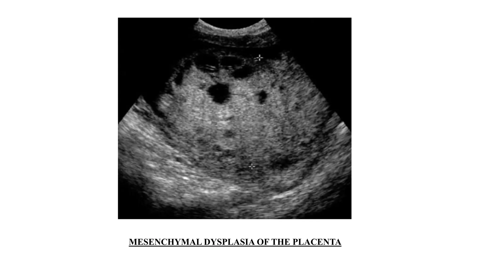 Sonographic Evaluation of Placenta.pptx