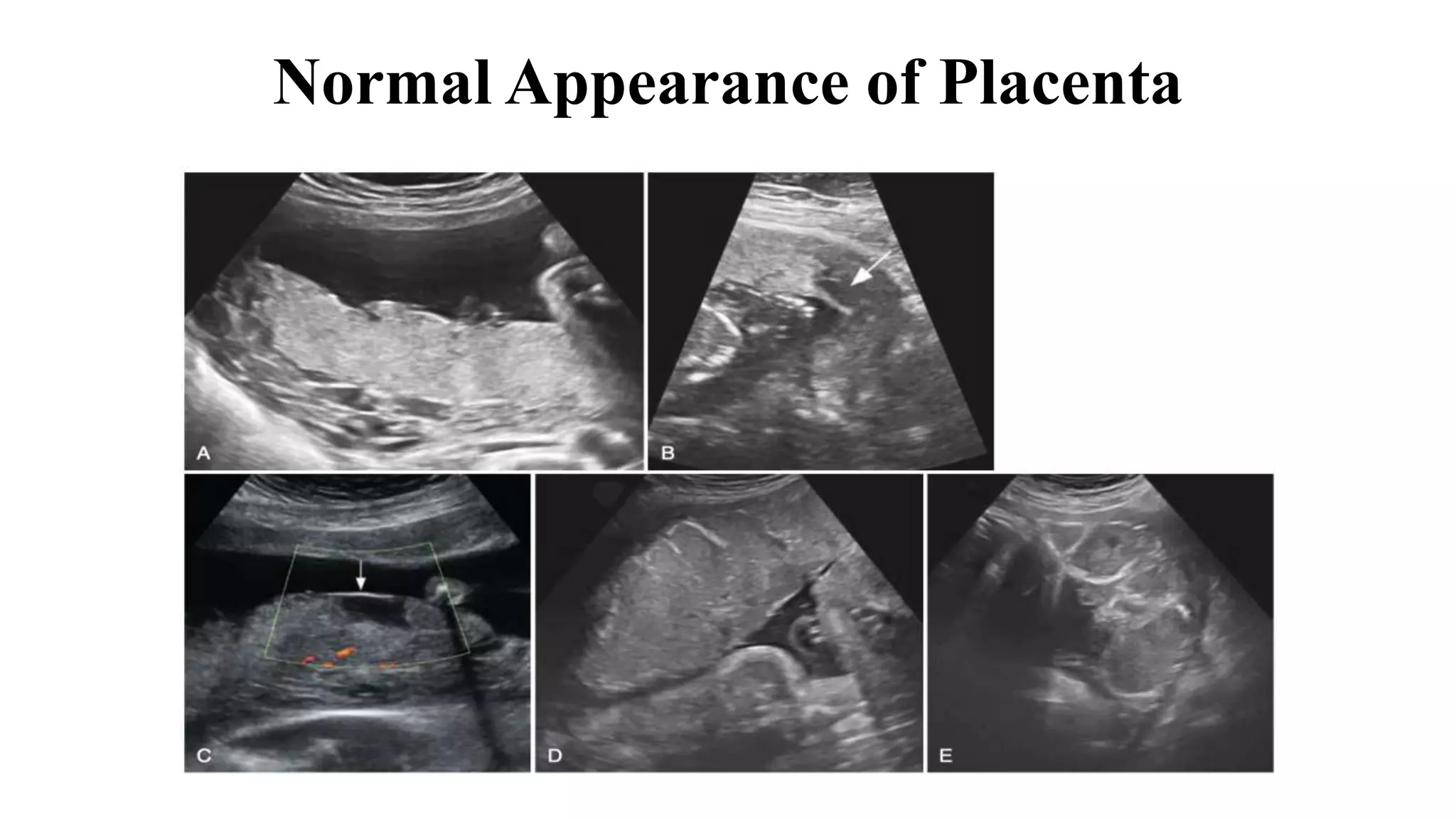 Sonographic Evaluation of Placenta.pptx
