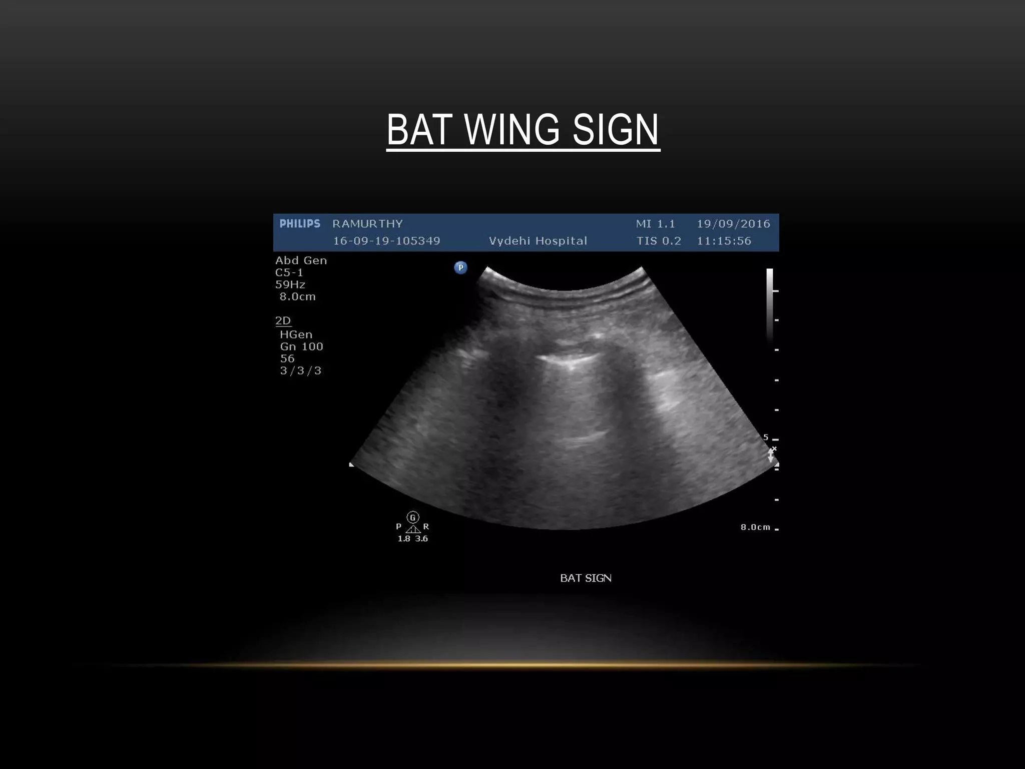 Sonographic features of pneumothorax dr suresh | PPTX