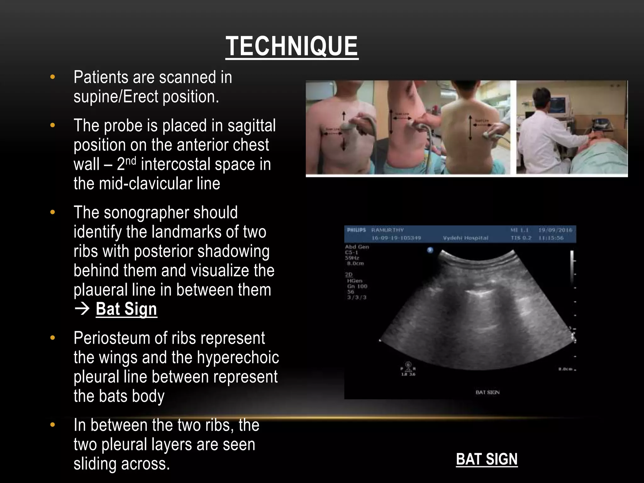 Sonographic features of pneumothorax dr suresh | PPTX