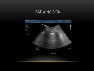 Sonographic features of pneumothorax dr suresh | PPTX