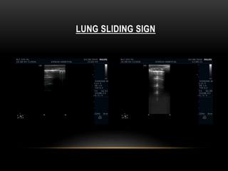 Sonographic features of pneumothorax dr suresh | PPTX