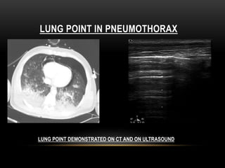 Sonographic features of pneumothorax dr suresh | PPTX