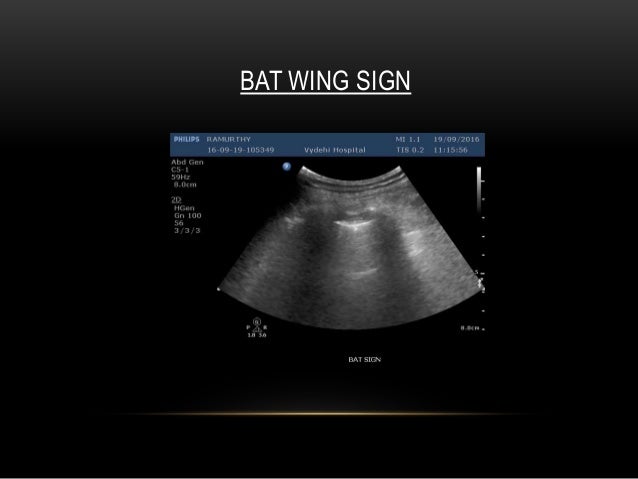 Sonographic features of pneumothorax dr suresh