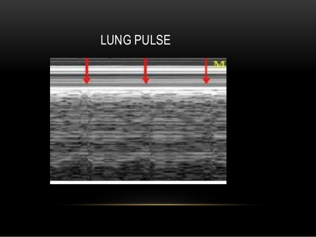 Sonographic features of pneumothorax dr suresh