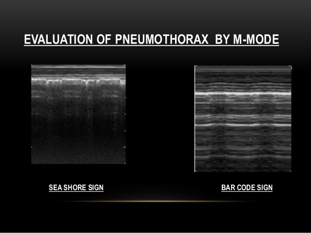 Sonographic features of pneumothorax dr suresh