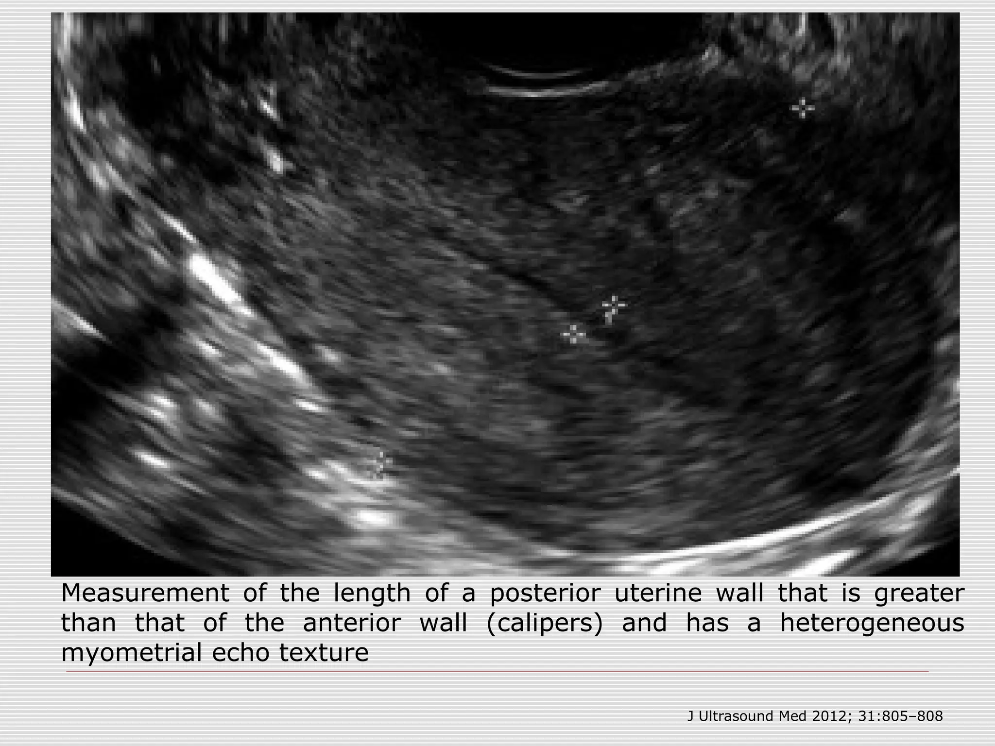 Sonography of adenomyosis | PPT