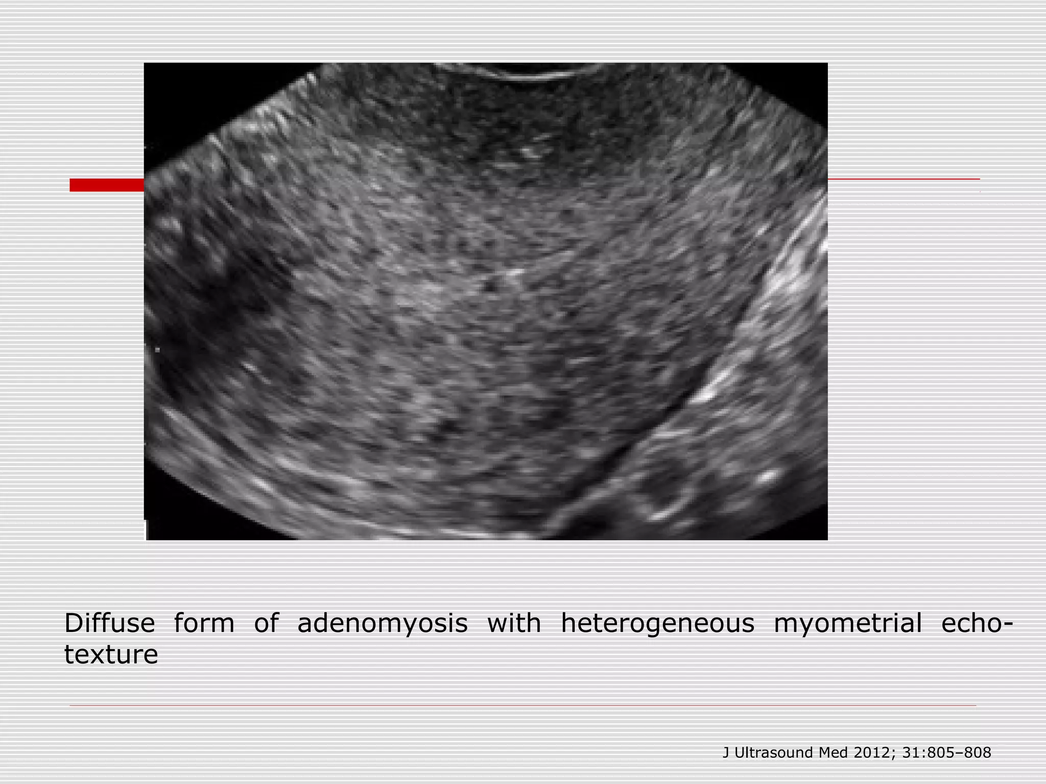 Sonography of adenomyosis | PPT